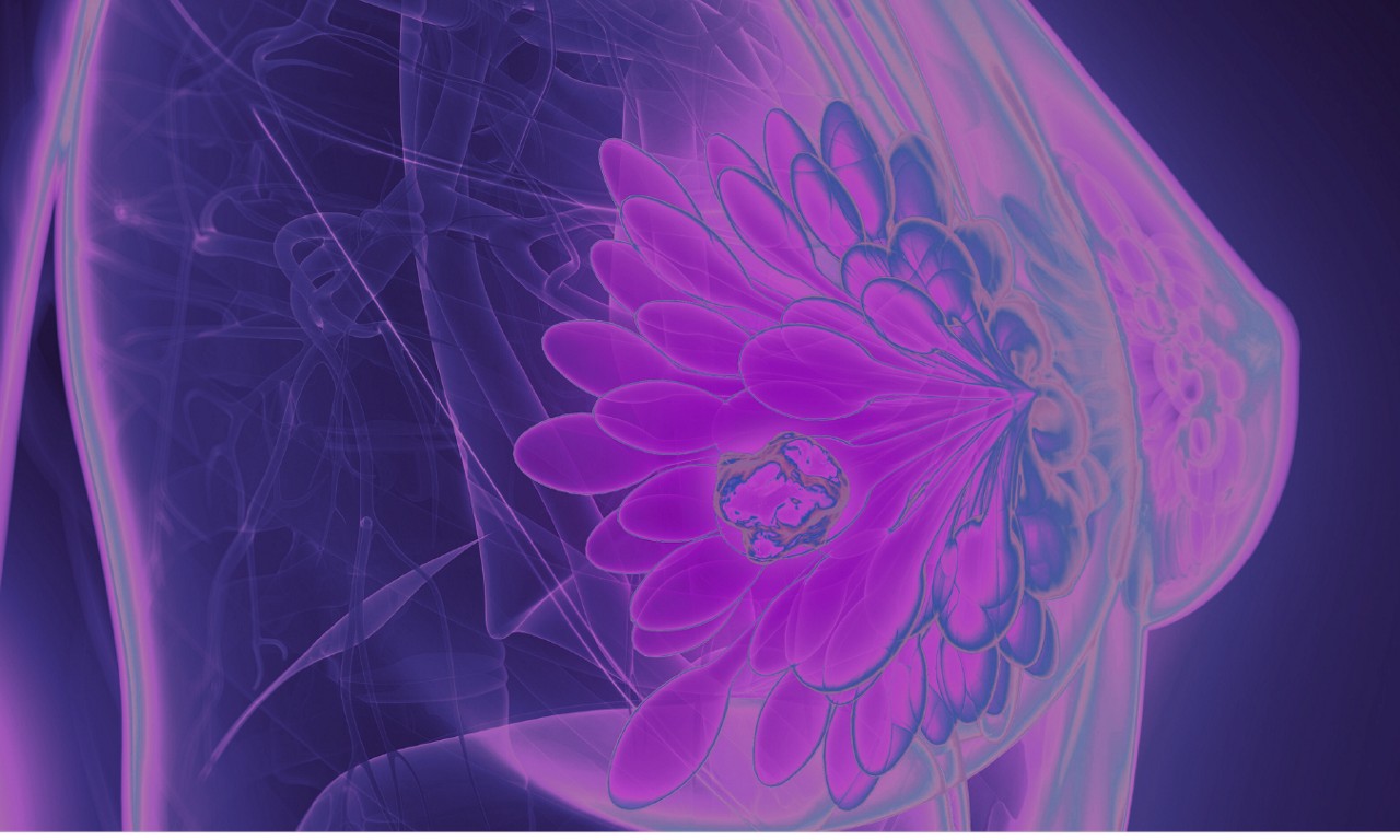 Simpósio internacional sobre diagnóstico do câncer de mama